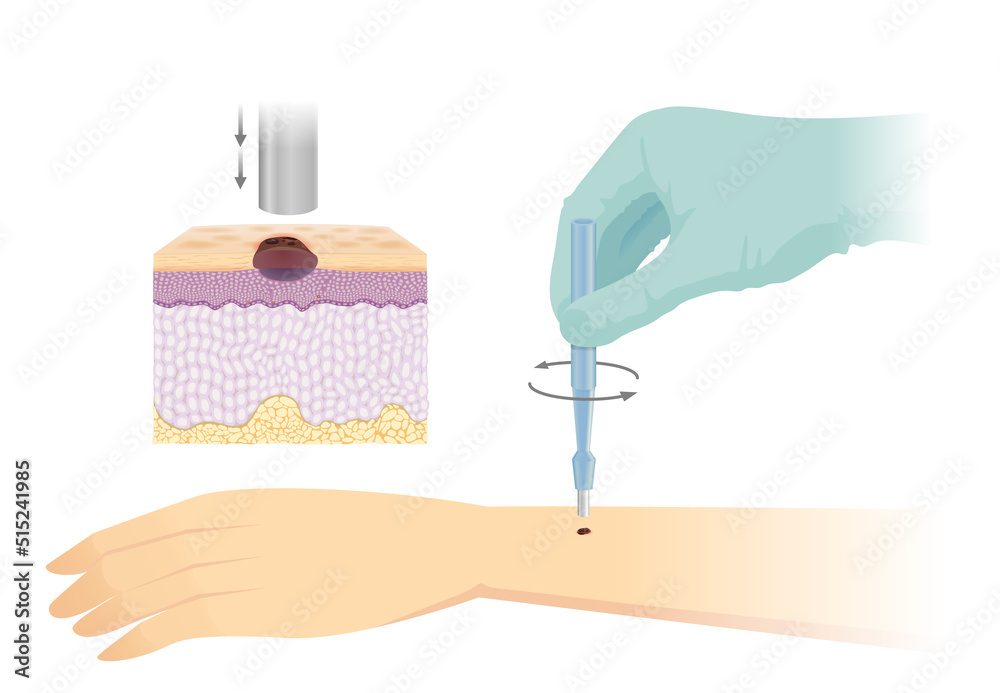 Use the Biopsy punches tool to pierce small tissue of skin layer for ...