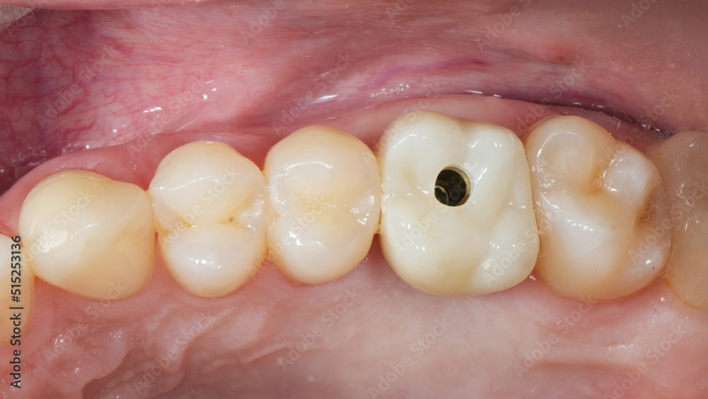 installed dental crown of the chewing tooth before closing the screw ...