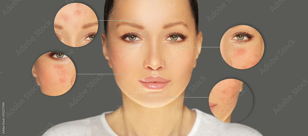 Acne,Skin concern,blemish-prone skin and acne, Rosacea,different types ...