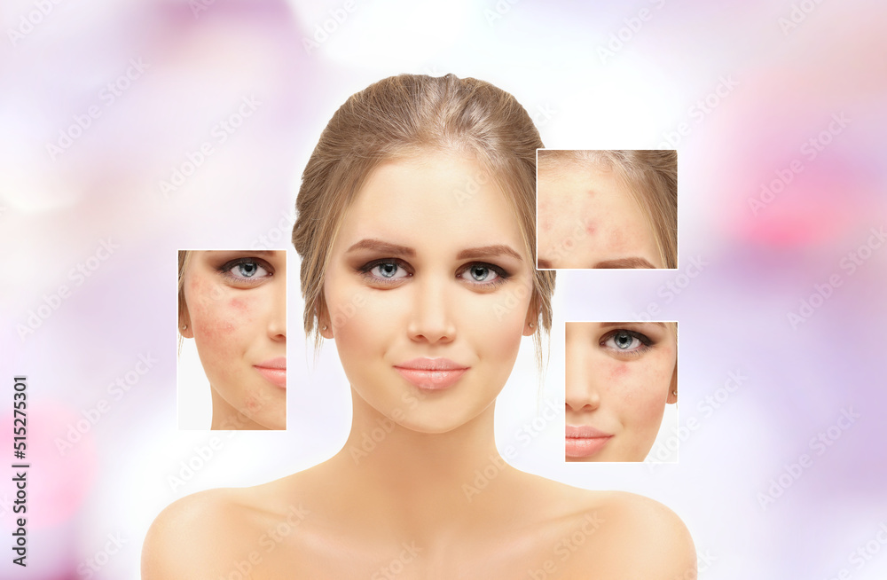 Acne,Skin concern,blemish-prone skin and acne, Rosacea,different types ...