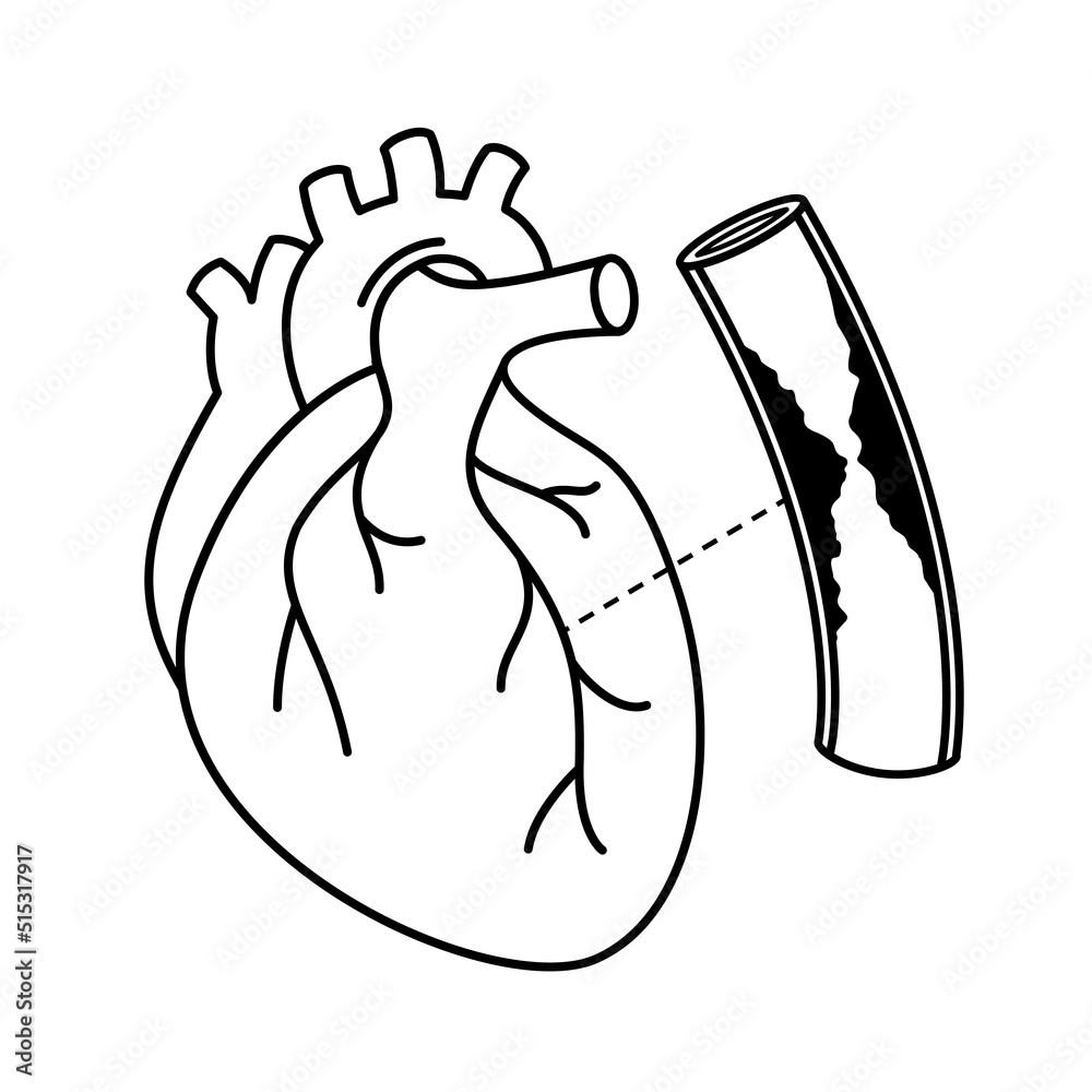 Human heart with Coronary Artery Disease. Outline info graphic. Blocked ...