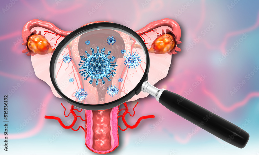 Virus, bacteria infected uterus with magnifying glass. 3d illustration ...