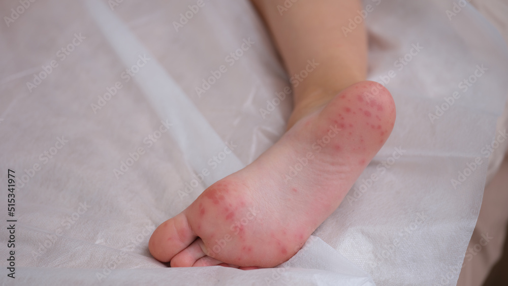 Child foot with red itchy rash closeup Stock Photo | Adobe Stock