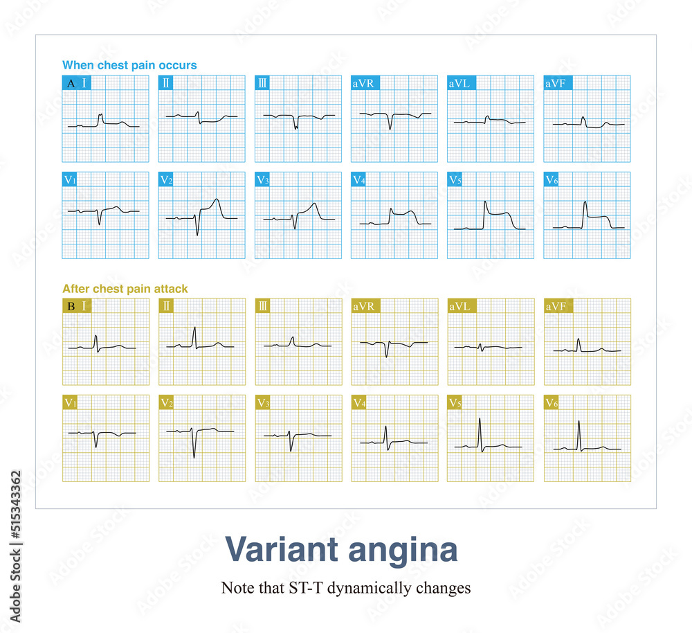 Female, 52 years old, with a history of hypertension for 10 years ...