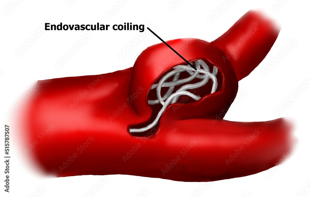 Treatment Of Cerebral Aneurysm With Endovascular Coiling Stock