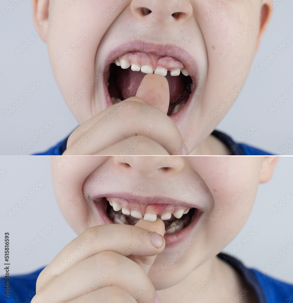 Before and after. Loose baby teeth. From above, the boy shows that the ...
