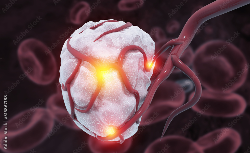 Tumor, destruction of a tumor cell, growing Tumor, 3d illustration ...