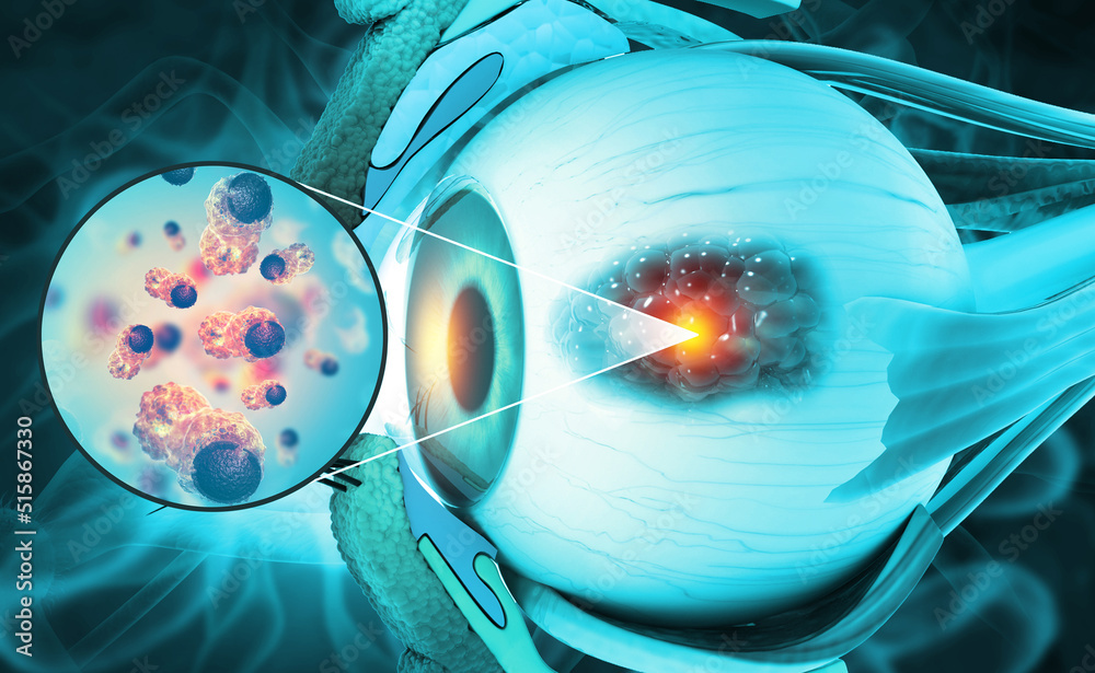 Eye cancer, eye disease, human eyeball with cancerous cells spreading ...