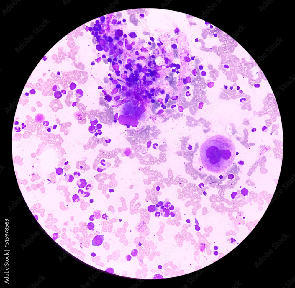 Microscopic view of bone marrow slide, acute myeloid leukemia(AML ...