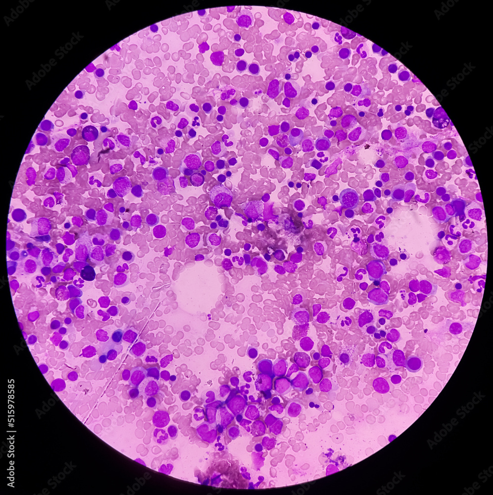 Microscopic view of bone marrow slide, acute myeloid leukemia(AML ...