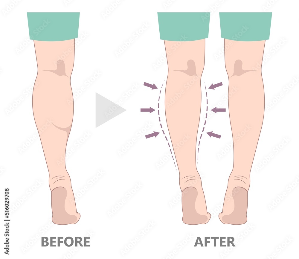 limb pain treat gastrocnemius polio leg calf resection deformity reduce ...