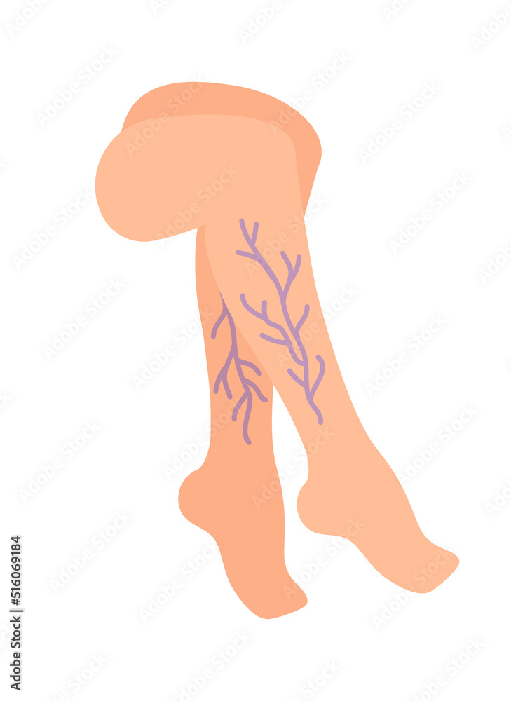 Varicose veins in the legs. Vascular or spider veins. Vector cartoon ...