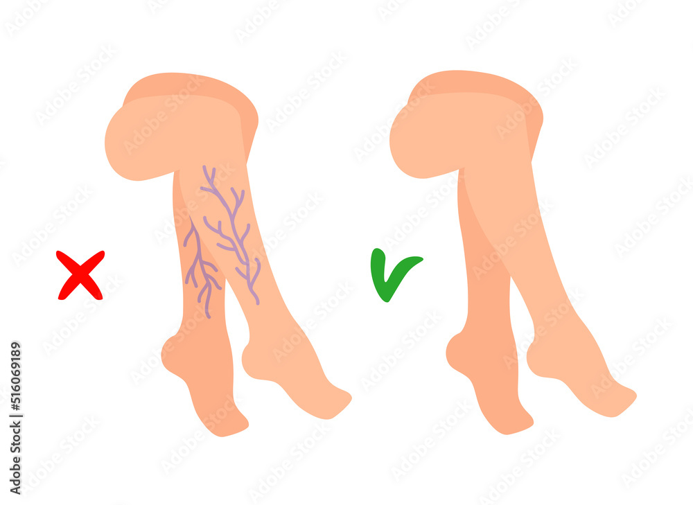Varicose veins in the legs. Vascular or spider veins and healthy clean ...