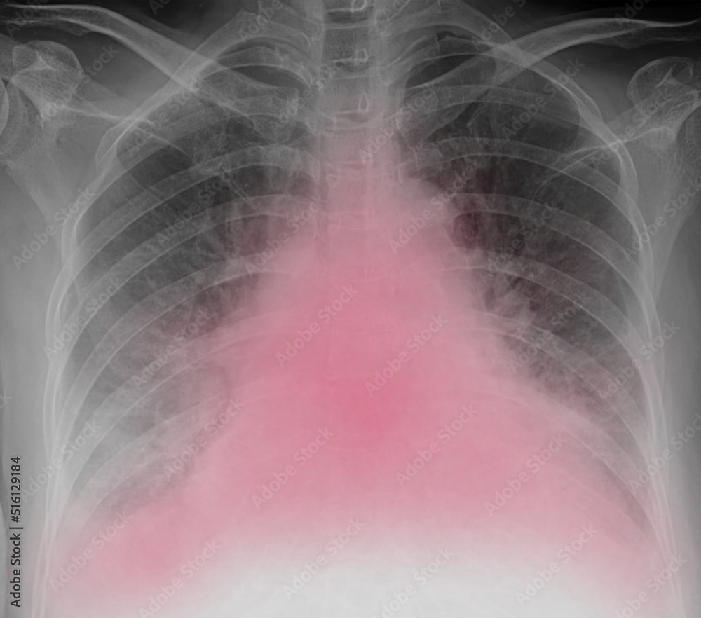 Enlarged Heart Cardiomegaly And Heart Failure Everyday