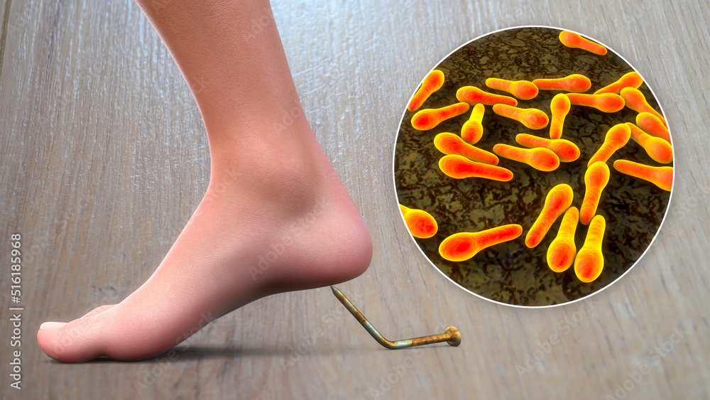 Transmission of tetanus bacteria by contaminated wounds, 3D conceptual ...