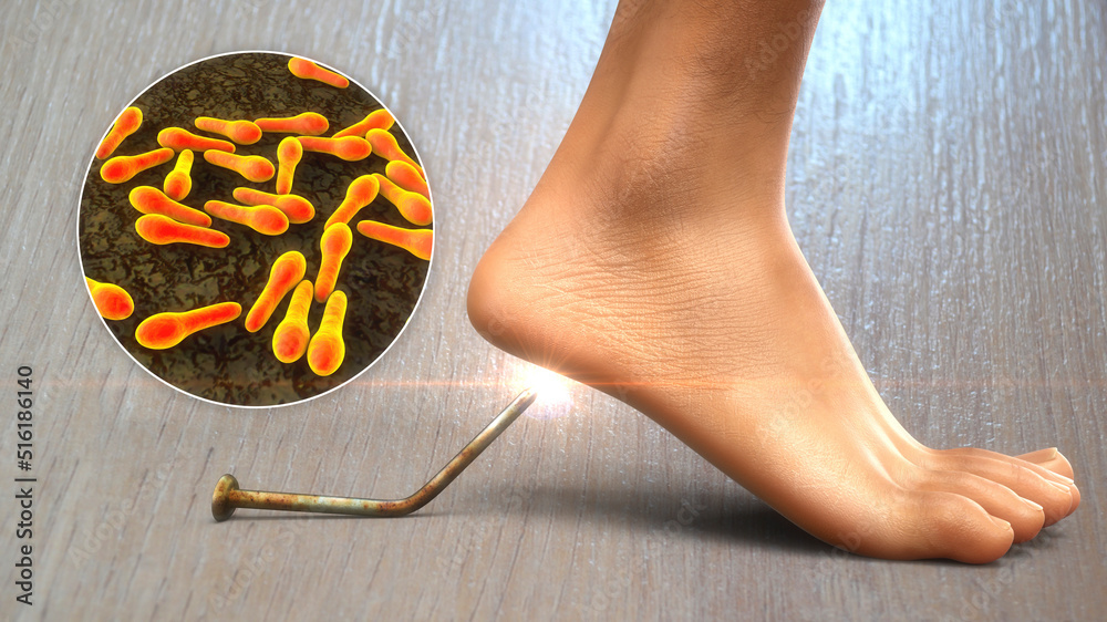 ภาพประกอบสต็อก Transmission of tetanus bacteria by contaminated wounds ...