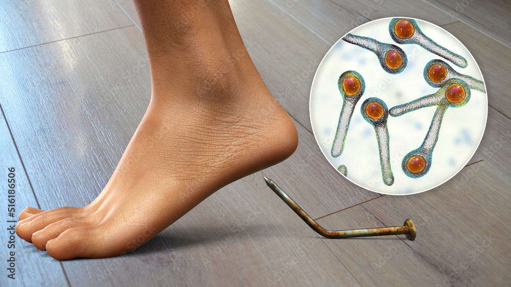 Transmission of tetanus bacteria by contaminated wounds, 3D conceptual ...