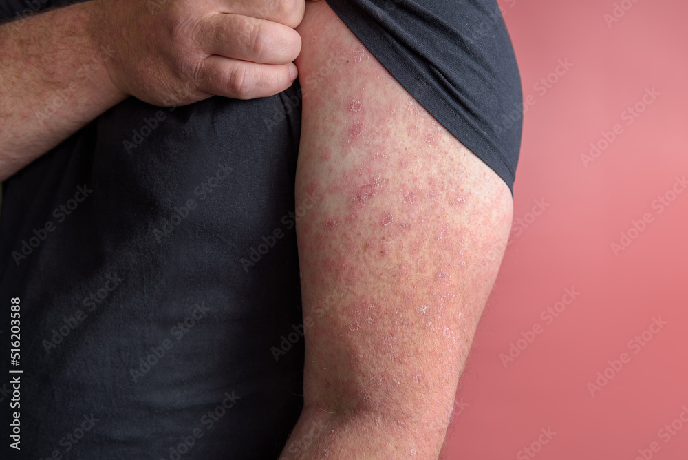 Erysipelas Red rash appears on the forearm. Close up Stock Photo ...