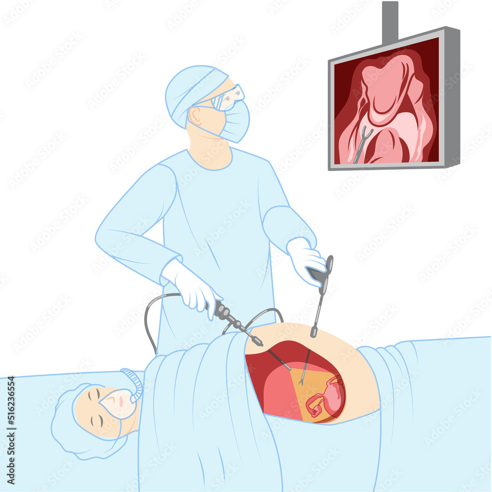 Laparoscopy keyhole surgery doctor with a patient surgical procedure ...