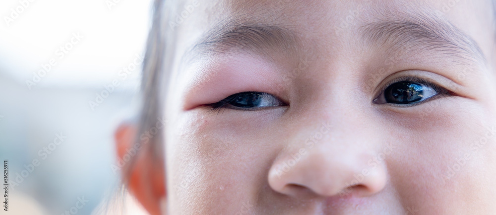 Stye Eye diseases. Closed Asian kid little girl eye with sty, eyelid ...