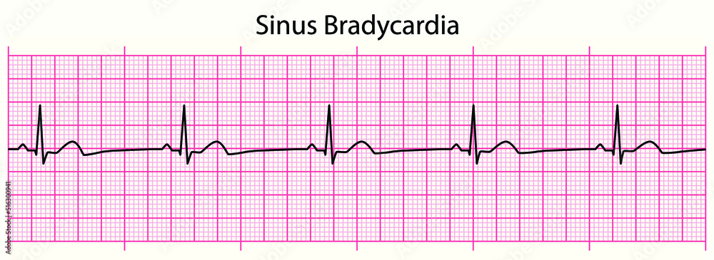 ECG line: Sinus Bradycardia in 6 second ECG paper line Векторный объект ...
