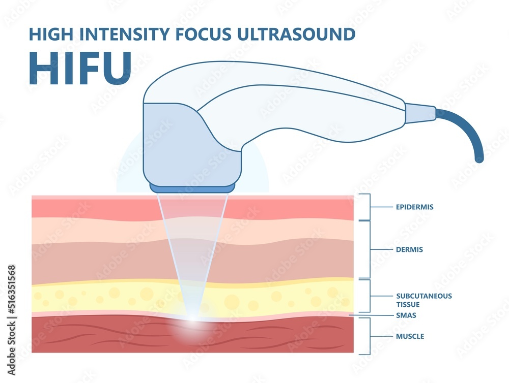 Anatomy of skin cell after the HIFU therapy or High Intensity Focus Ultrasound face saggy treat ...
