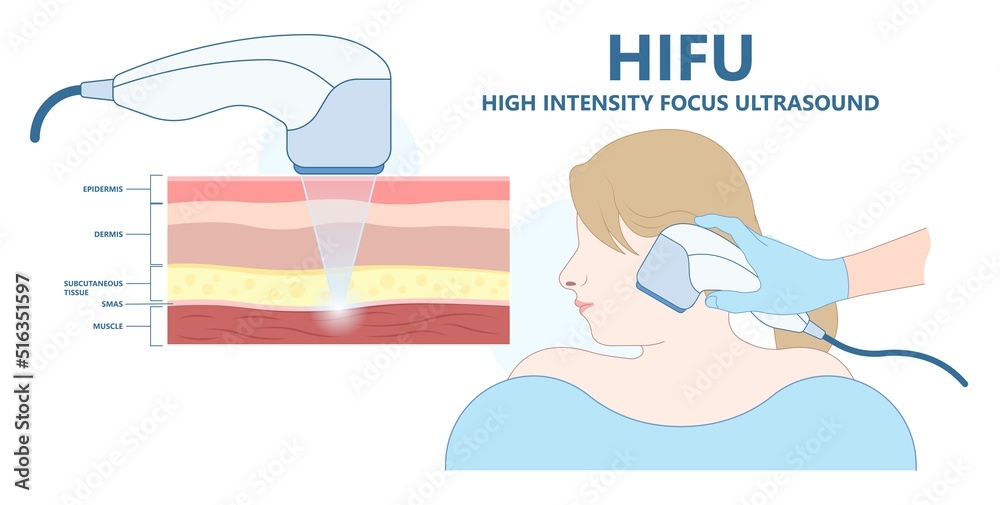 Women facial lift and droopy double chin scar with HIFU Therapy or High ...