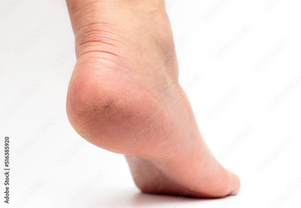A woman's foot heel close-up with problematic dry skin and cracks in ...