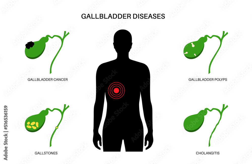 Vetor de Gallbladder diseases poster do Stock | Adobe Stock