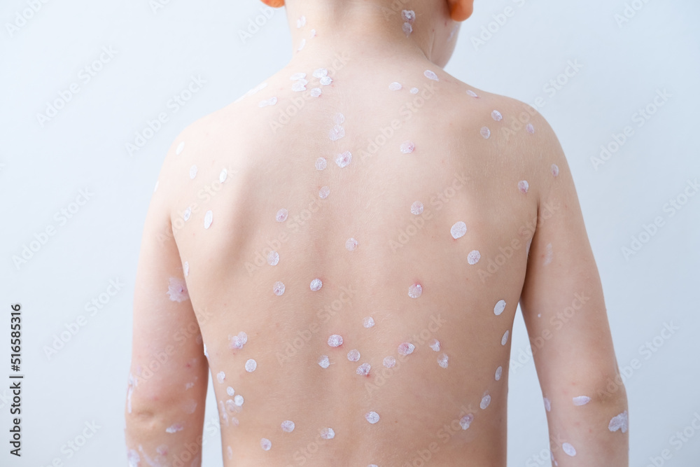 back of blonde little boy with red rashes Chicken pox virus, varicella ...