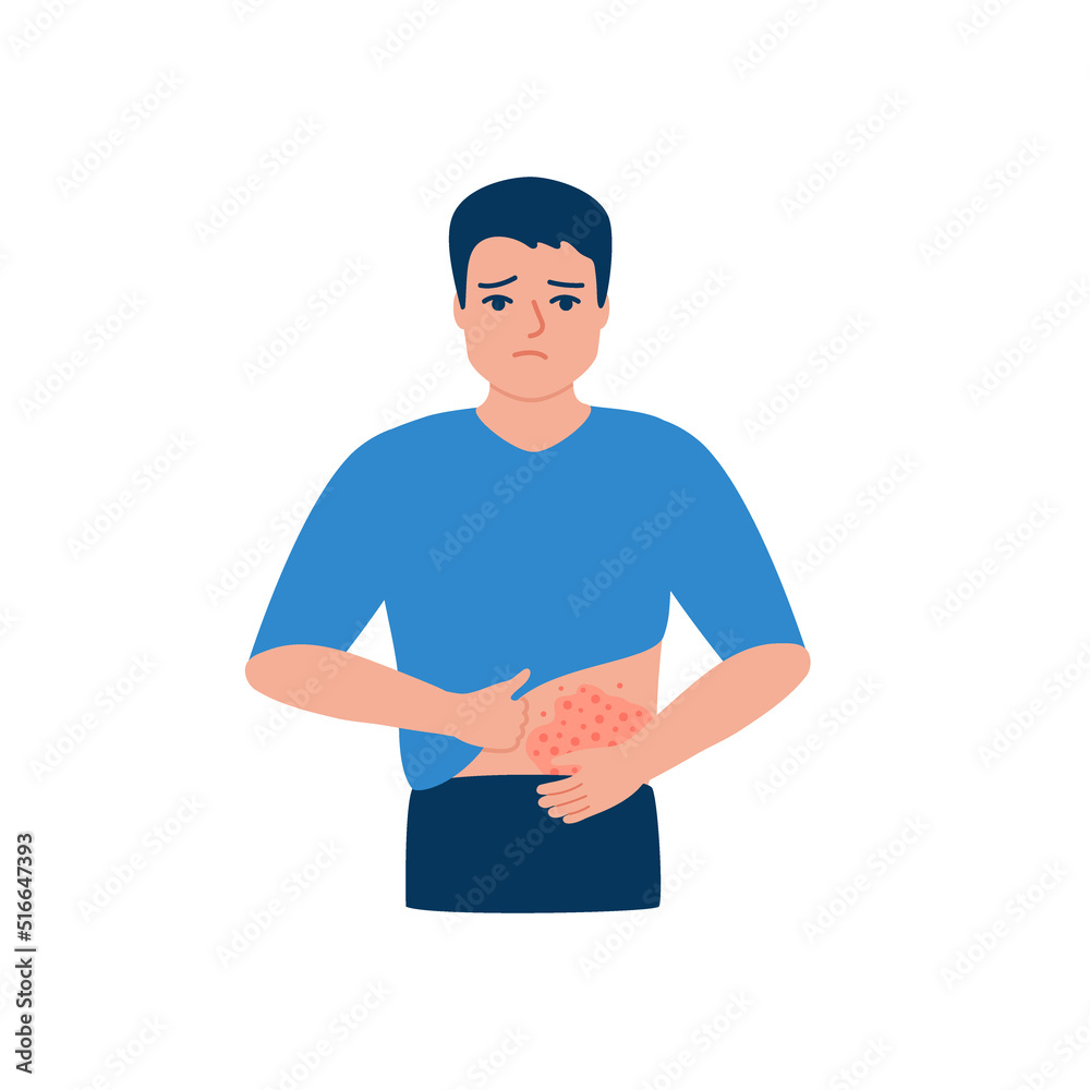 Man scratching body belly, rash, allergy, acne on skin. Male suffering ...