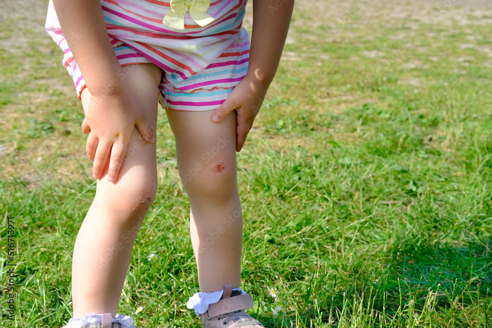 fresh wound, bleeding abrasion on knees of girl child fell on walk ...