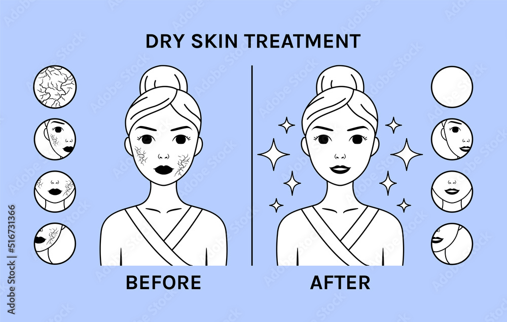 Treatment of Dry Skin. Woman with Dry skin on Face. Before After. Clean ...