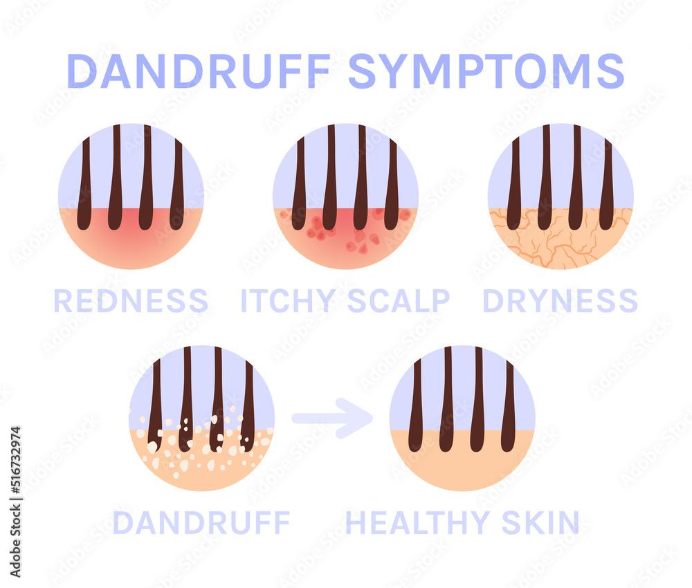 Itchy Scalp Dandruff