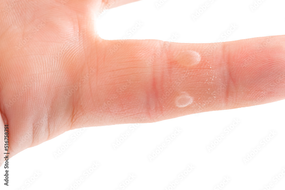 On hand finger there are blisters callus. Medical trauma with dry skin ...