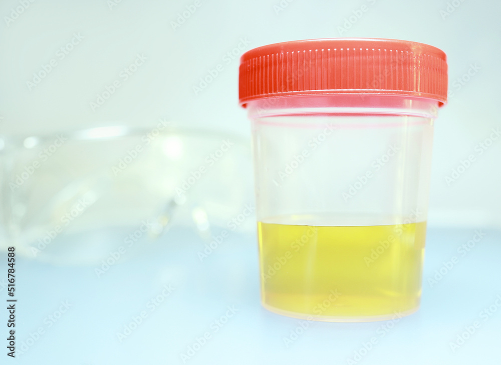 Urine sample in a biomaterial container. Medical urine test. Medical ...