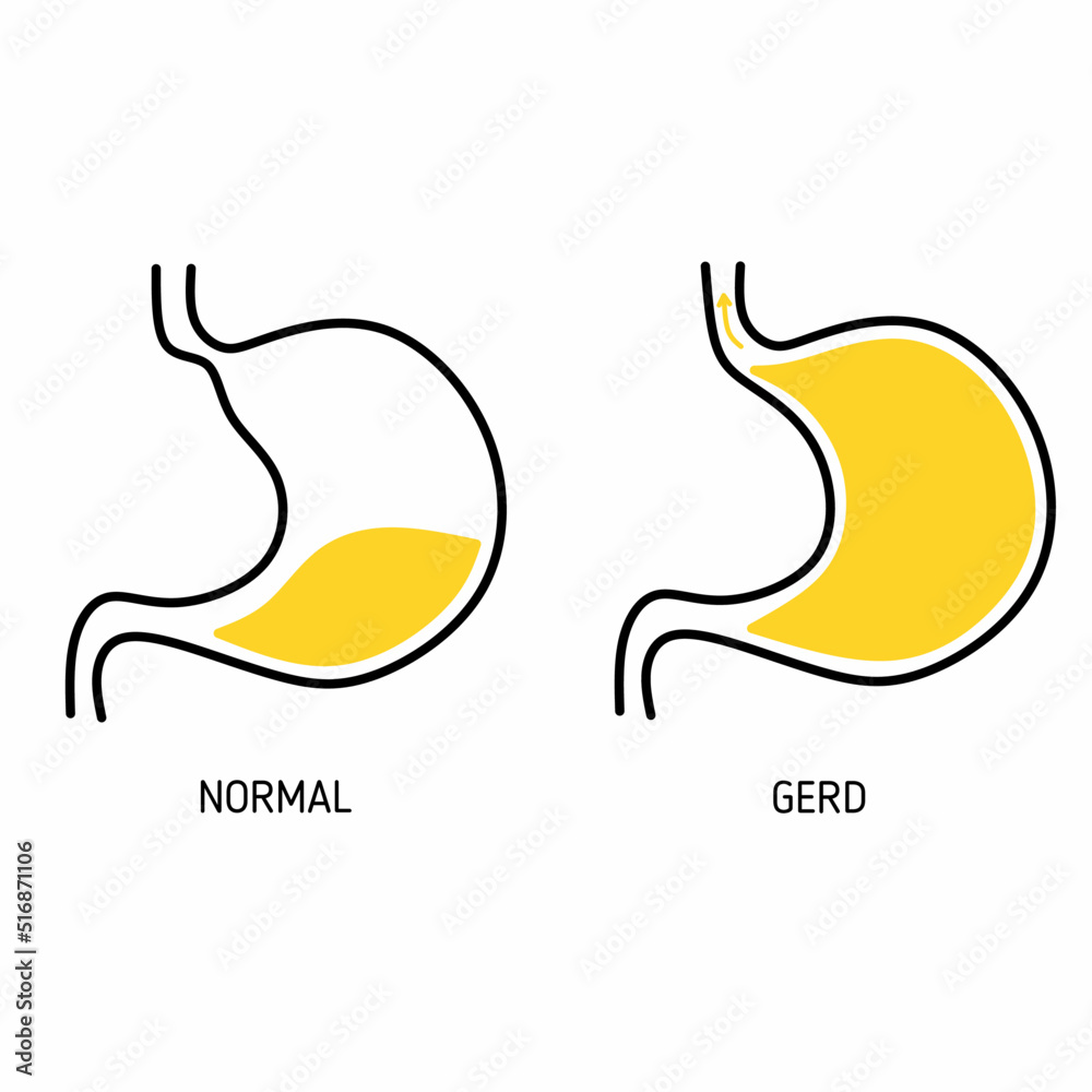 Vector illustration of Gastroesophageal Reflux Disease digestive ...