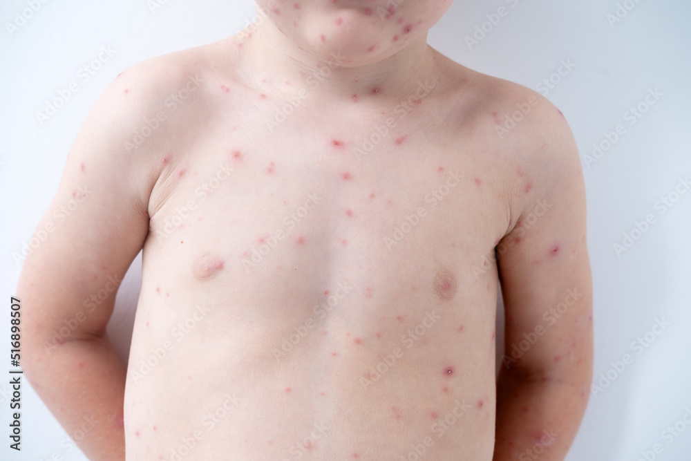 Chickenpox disease, portrait of blonde little boy with red rashes ...