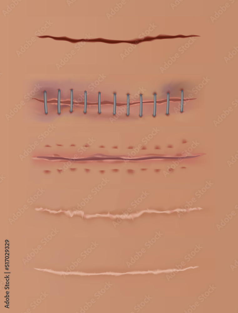 Healing wounds set, skin scars, stitched gash and cuts. Realistic ...