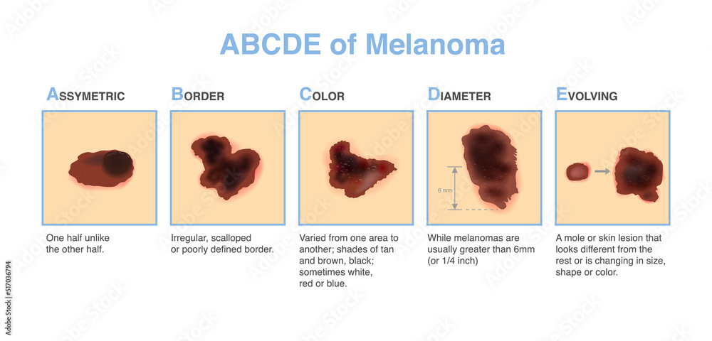 Different characteristics of skin damage. ABCDE stands for asymmetry ...