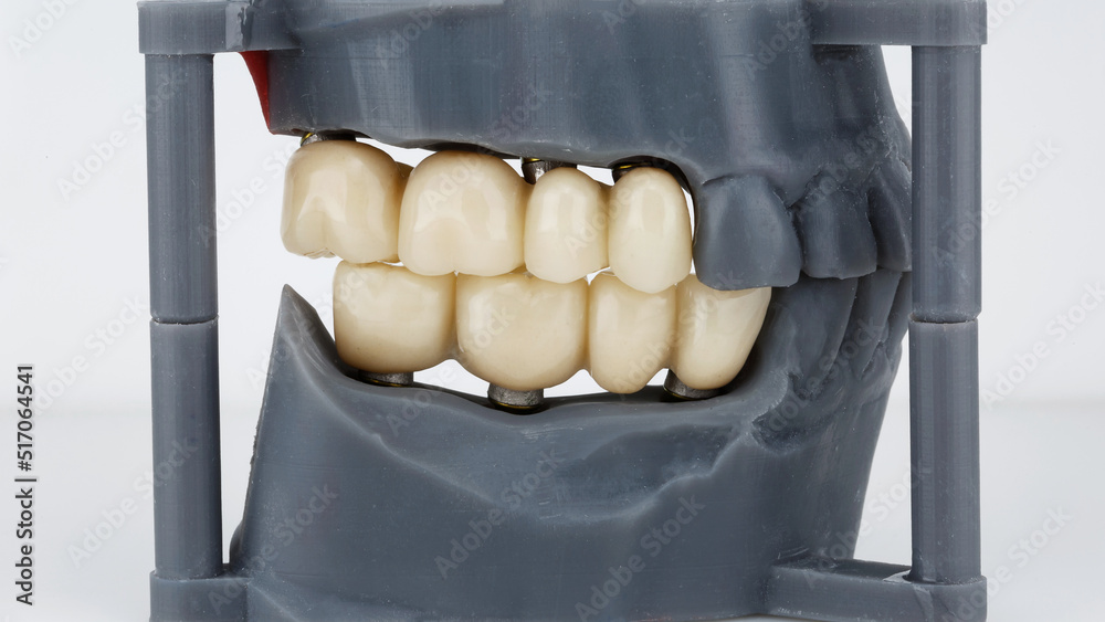 two dental models with support in the occlusion with prostheses on the ...