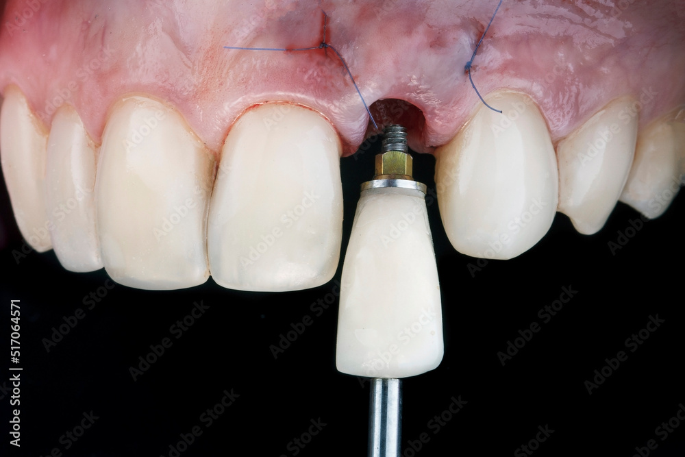 installation of a dental crown after implantation on a black background ...