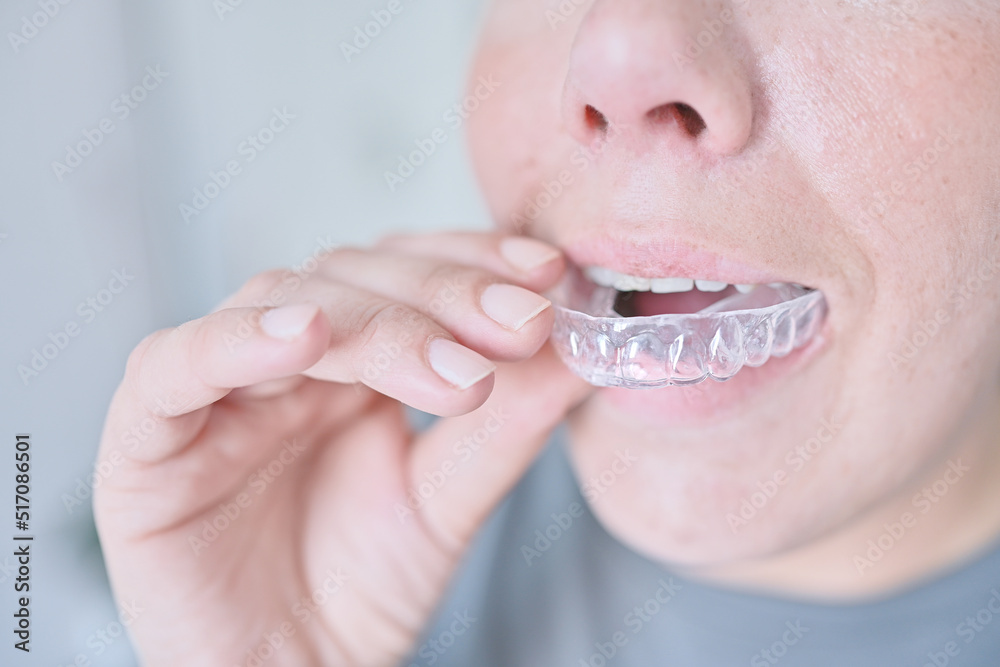 Stockfoto med beskrivningen Orthodontic teeth corrector. Woman adjusts ...