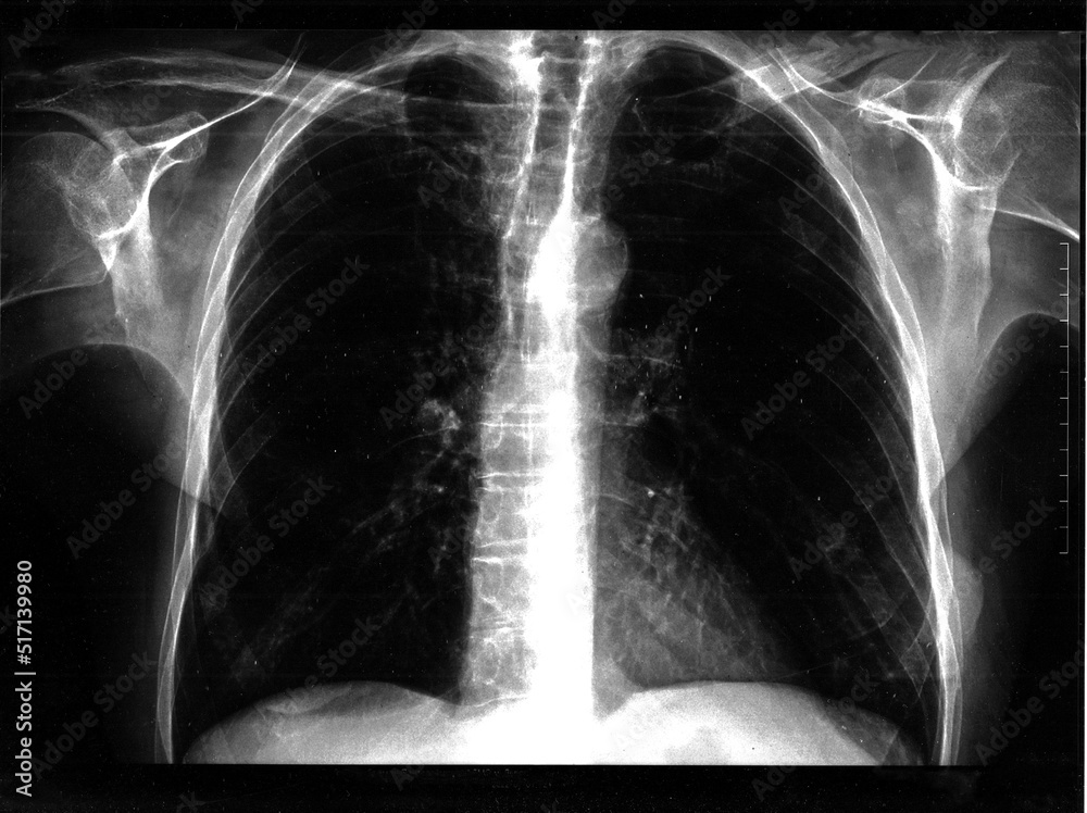 X-ray of the chest and lungs of a 72-year-old man. Stock Photo | Adobe ...