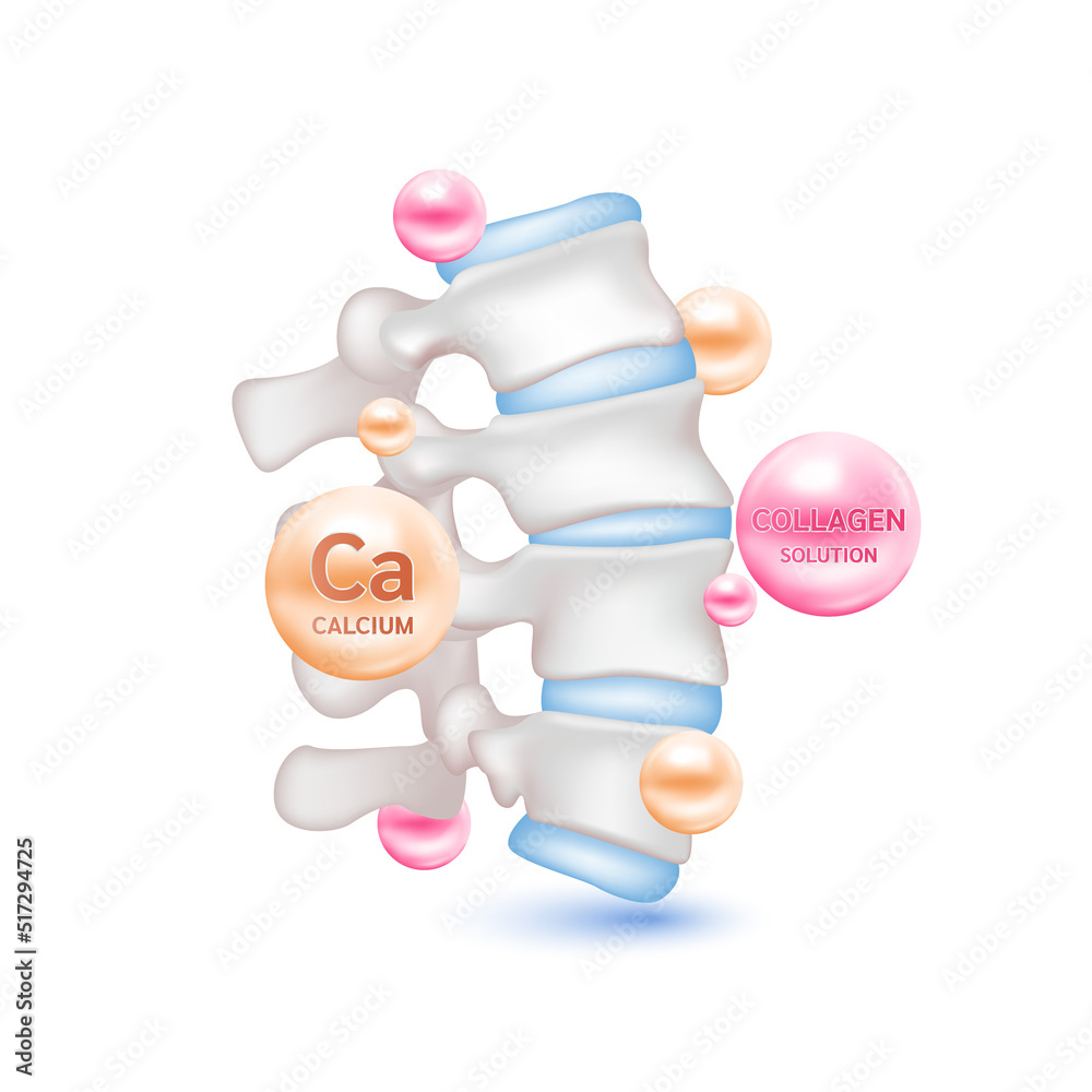 Calcium collagen vitamin therapy. Help heal backbone disc arthritis ...