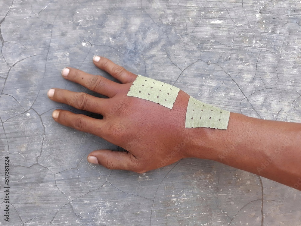 Swollen back of the palm due to dislocated of the bones or insect bee ...