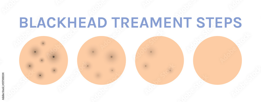 Facial Blackhead on Human Skin. Problem Skin Treatment. Step. Dirty and ...