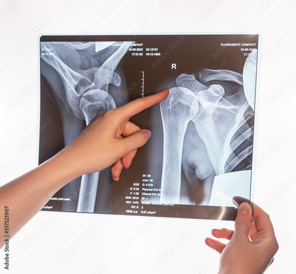 Forefinger pointing to trauma at shoulder, clavicle X-ray image ...