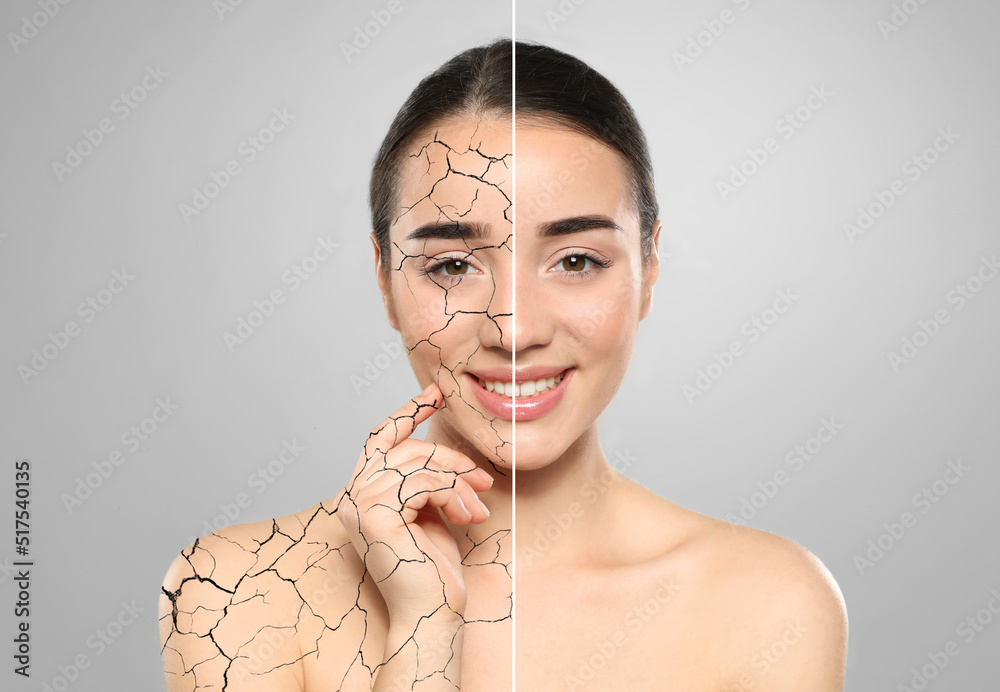 Collage with photos of woman having dry skin problem before and after ...