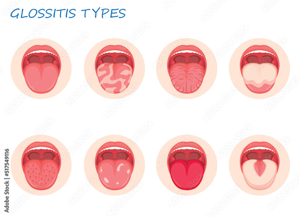 Glossitis Tongue Red, Ulcerative, etc at Marquette University - StudyBlue